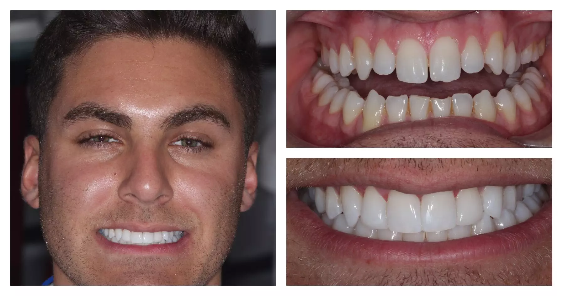 Dental Bonding in Fremont, CA | Cedar Dental Care